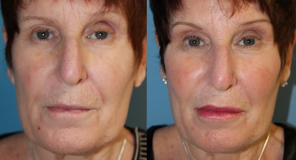 Will Fat Injections Replace Facial Fillers? - The Plastic Surgery Channel