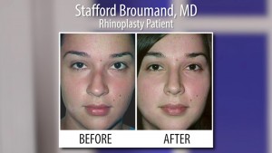 The Perfect Nasal Profile - The Plastic Surgery Channel