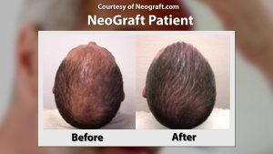 NeoGraft: Advanced Hair Transplantation Technology - The Plastic ...