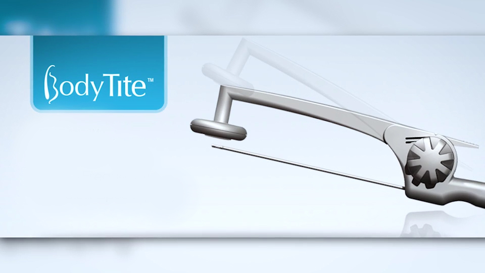 BodyTite – A New Player in Skin Tightening and Fat Removal - The ...